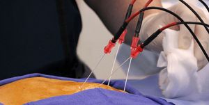 South West Ontario Pain Interventions (SWOPI) | Our Treatment Procedures